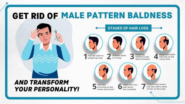 Everything You Need to Know About Male Pattern Baldness - BlueMagic Group