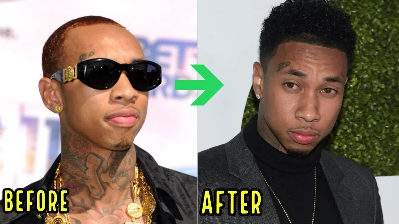 Tyga Hair Transplant - BlueMagic Group Clinic
